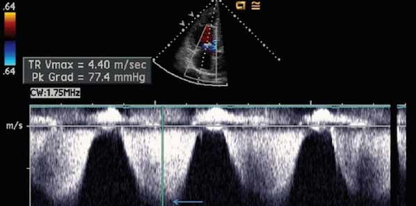 Measuring MPAP: Echocardiography Vs. Catheterisation