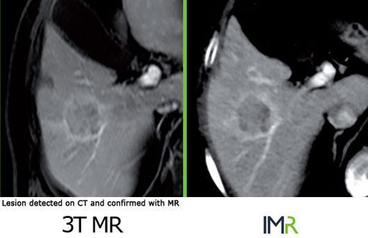 Philips Imr Enhancements