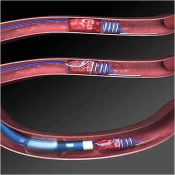 AHA Recommends Stent Retrieval for Select Stroke Patients