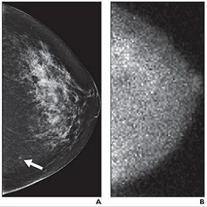 MBI: Cost-Effective Secondary Breast Screening Method