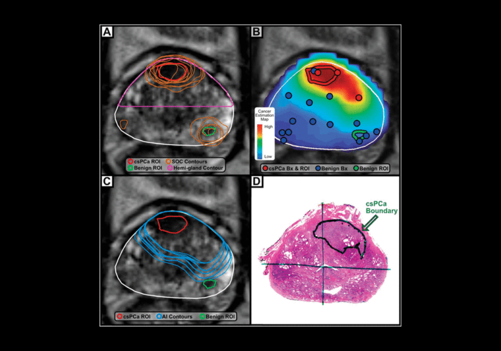 AI-Assisted Contouring in Prostate Cancer: Enhancing Accuracy ...