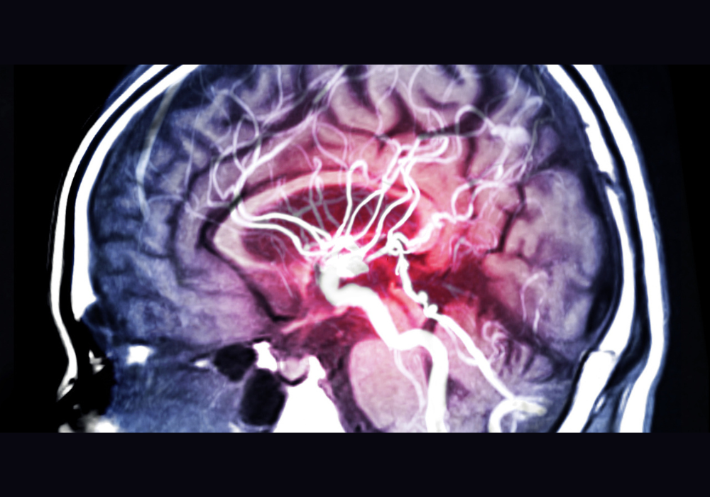 Cerebral Aneurysm Detection through Deep Learning: A Multicentre Study