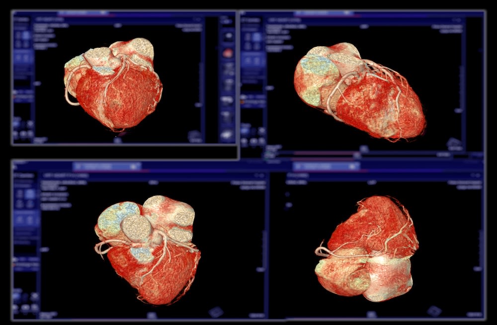 SCAI/SCCT Expert Opinion: CCTA to Guide PCI