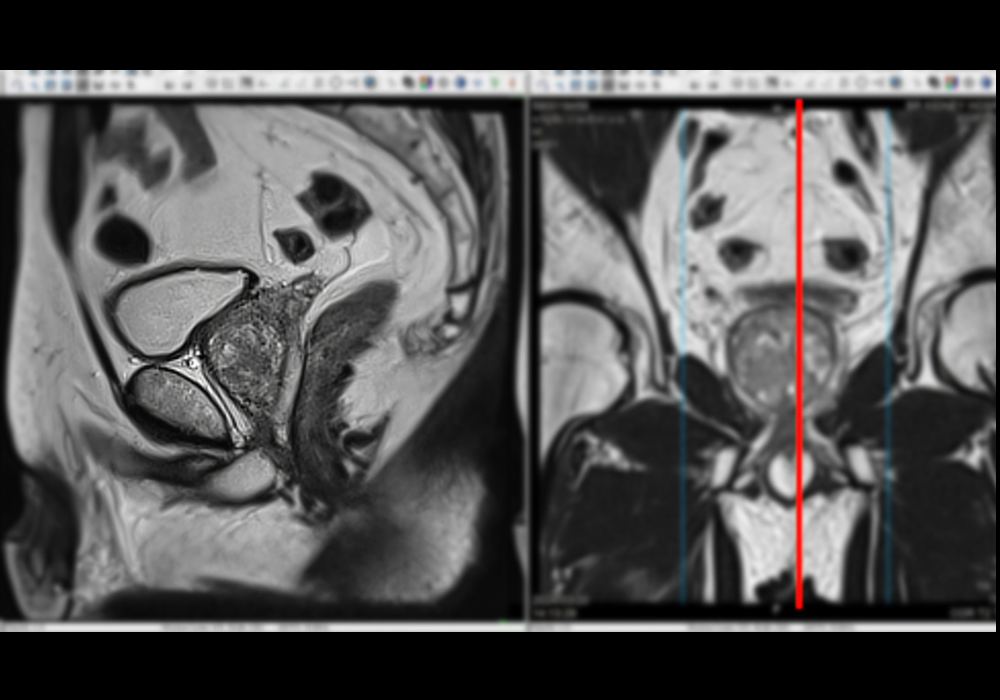Prostate Cancer Detection with Minimal MRI Data