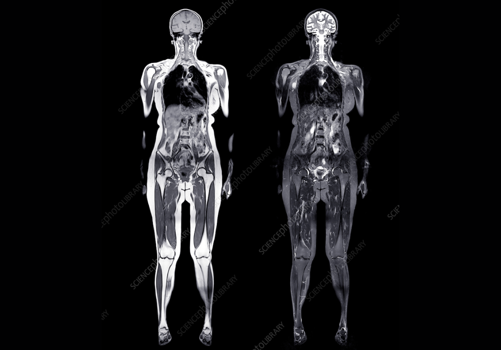 Dixon Fat-Water MRI in Musculoskeletal Imaging