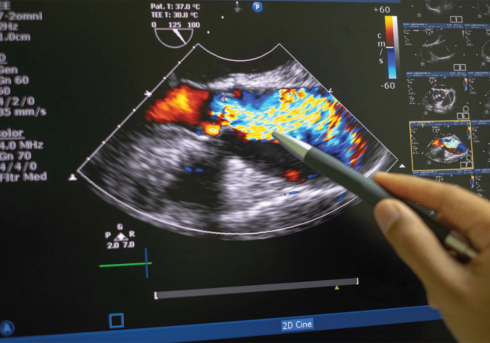 Deep Learning Advances in Ultrasound Segmentation