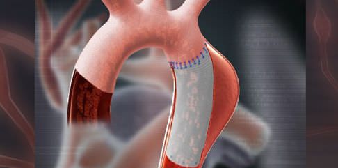 Health Management and Leadership Portal | Thoracic stent graft Cronus ...